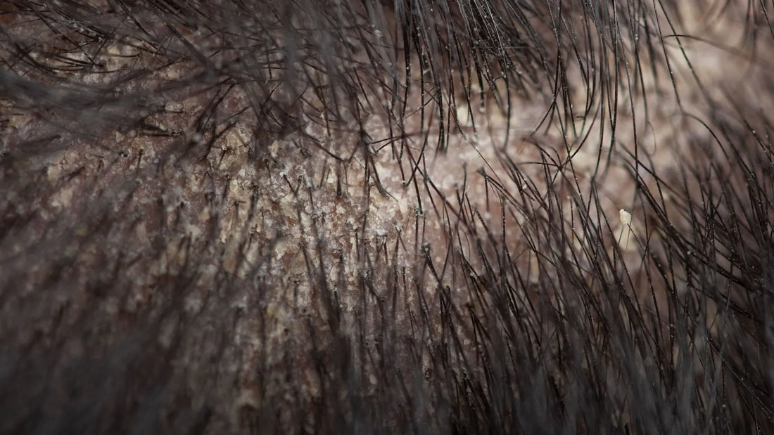 What causes seborrheic dermatitis on the scalp and how to treat it ...