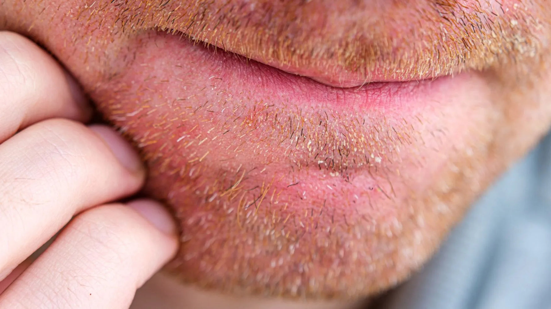 What is Seborrheic Dermatitis on the Face and How to Treat It? – QRxLabs
